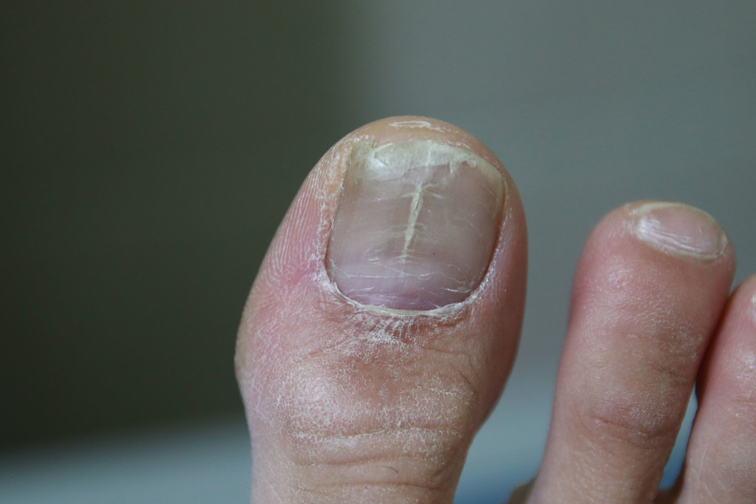 Frisco Split Toenail • Frisco Foot & Ankle Specialists