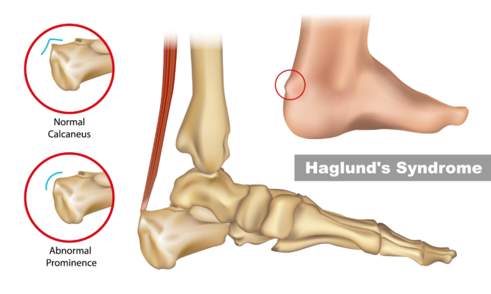 Haglund’s Deformity | Frisco Foot & Ankle Specialists